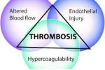 Thrombose: Virchow´sche Trias